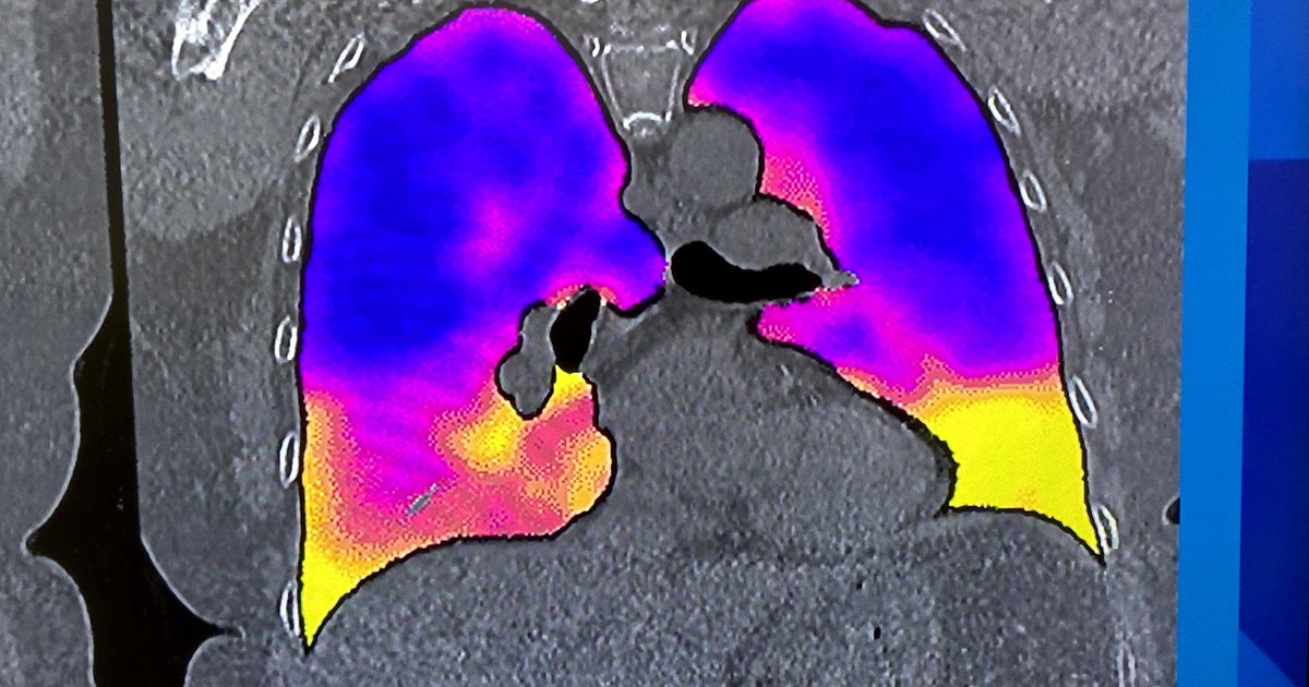 4DMedical lands $100M in new funding to scale functional lung imaging ...