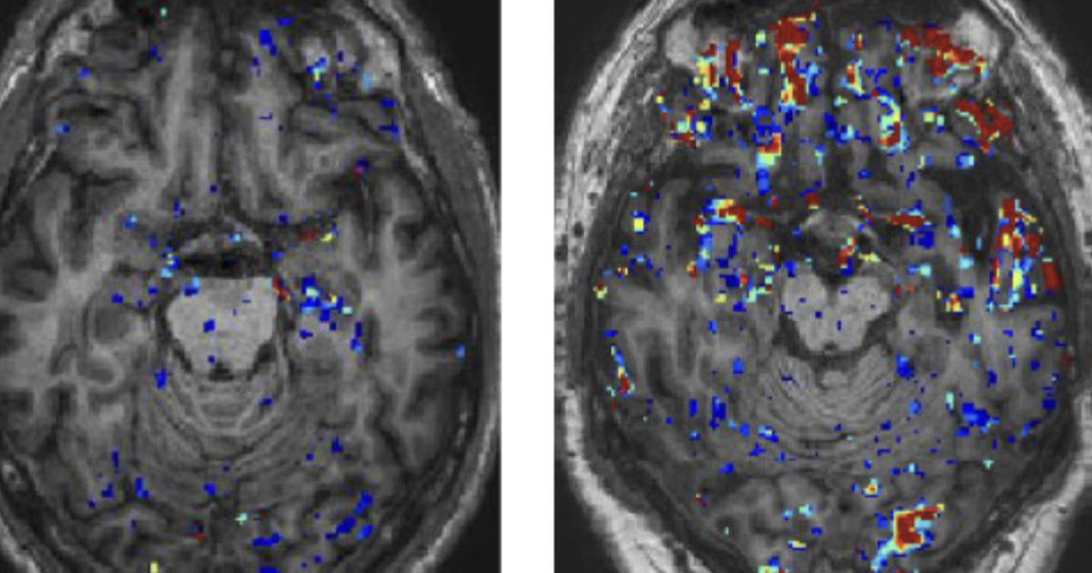 MRI findings detail how a 'leaky' barrier can damage the brain years ...