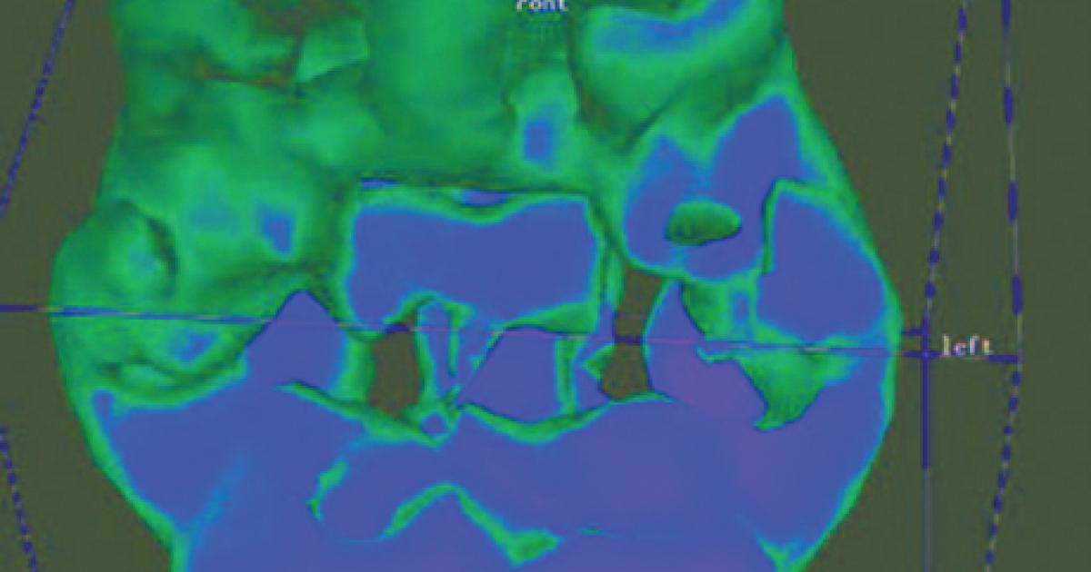 Is SPECT imaging accurate in predicting nigral neurons in Parkinson's ...