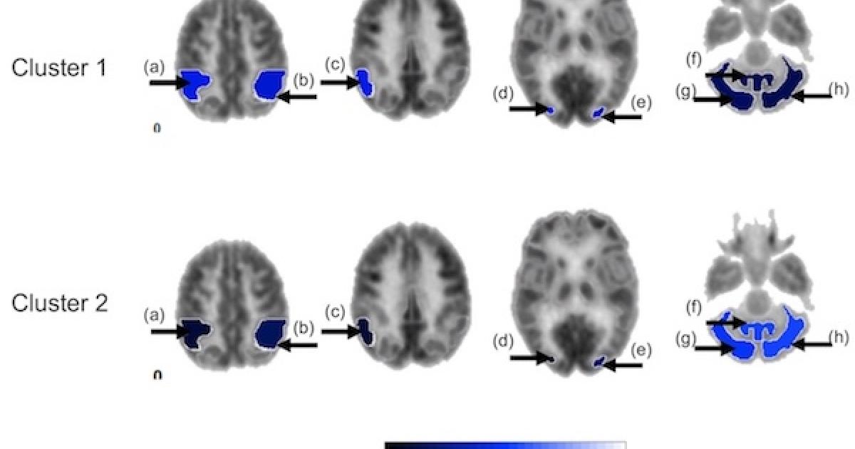 Pre-procedure imaging may predict success of epilepsy surgery