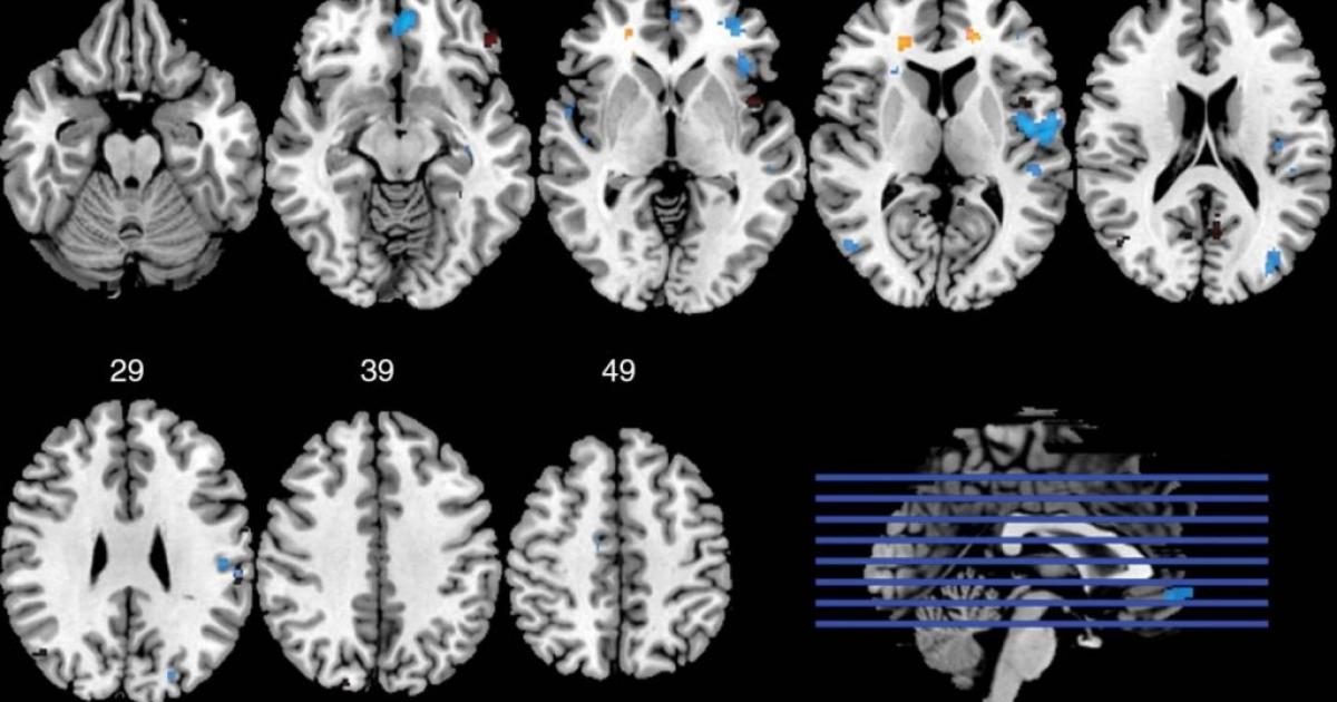 Brain impact of football affected by career length, player's position