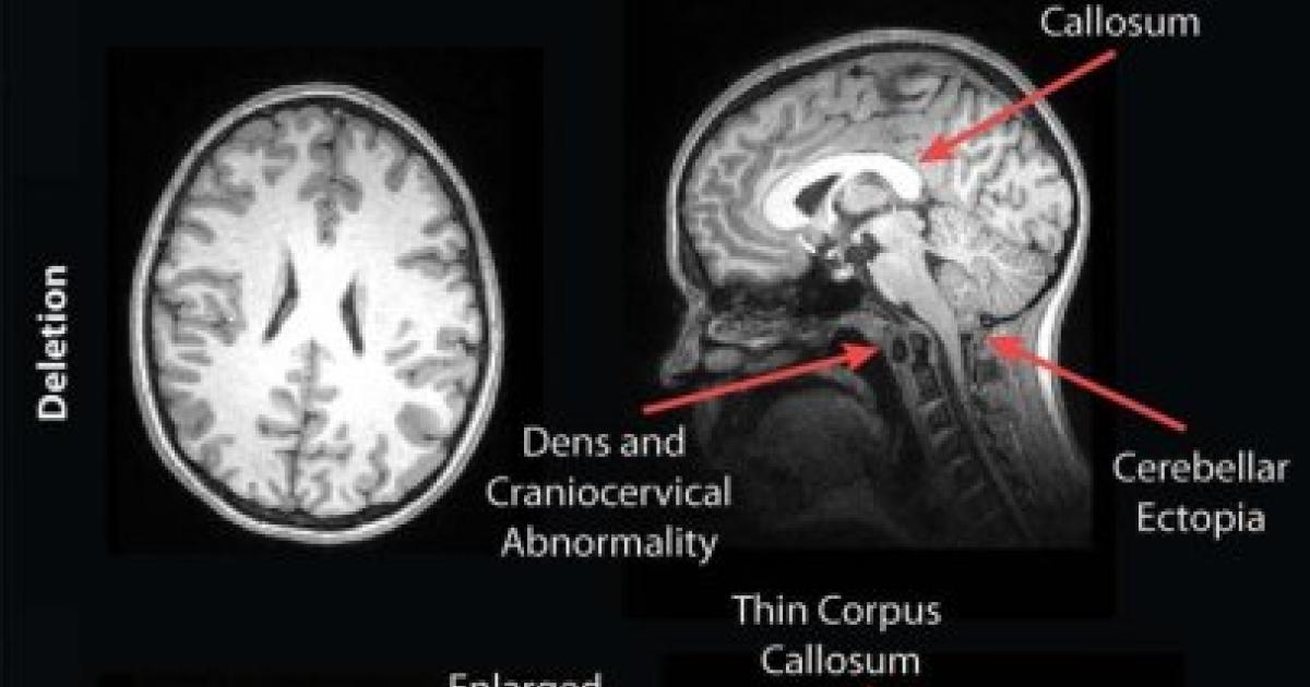 MRI connects genetic autism, structural abnormalities in brain