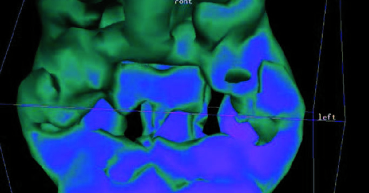 A 3D brain SPECT could lead to better cognitive function in psychiatric ...