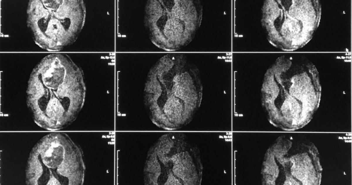 How one institution successfully introduced BT-RADS to radiologists
