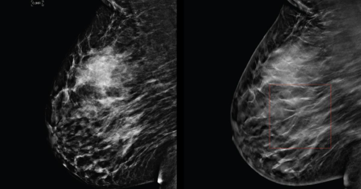 Imaging department reaps benefits of tomo after careful implementation