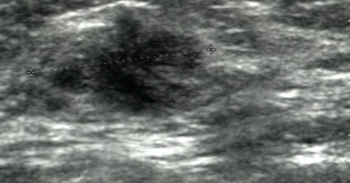 When it comes to detection, can ultrasound be mammography’s equal?