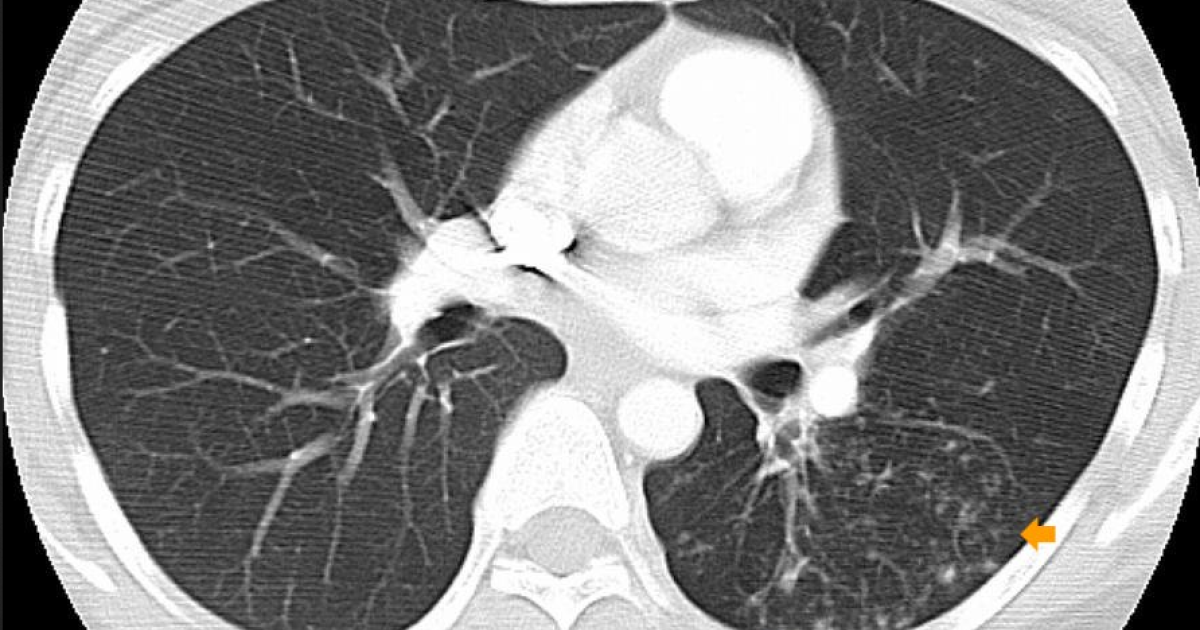 How do Omicron and Delta compare on chest imaging?