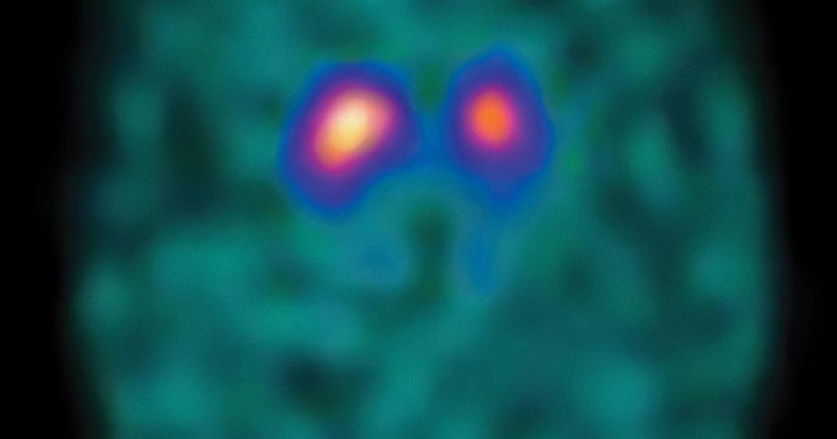 AAN: DaTscan SPECT on display for diagnosis of dopamine disorders