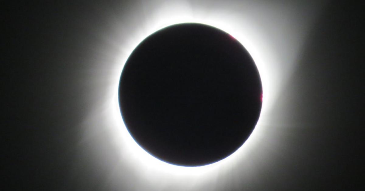 Sun burned: Ophthalmoscopy spies woman's retinopathy after solar eclipse