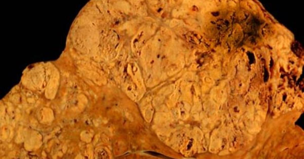 Q&A: SIR honors Riad Salem for using radioembolization to treat liver ...