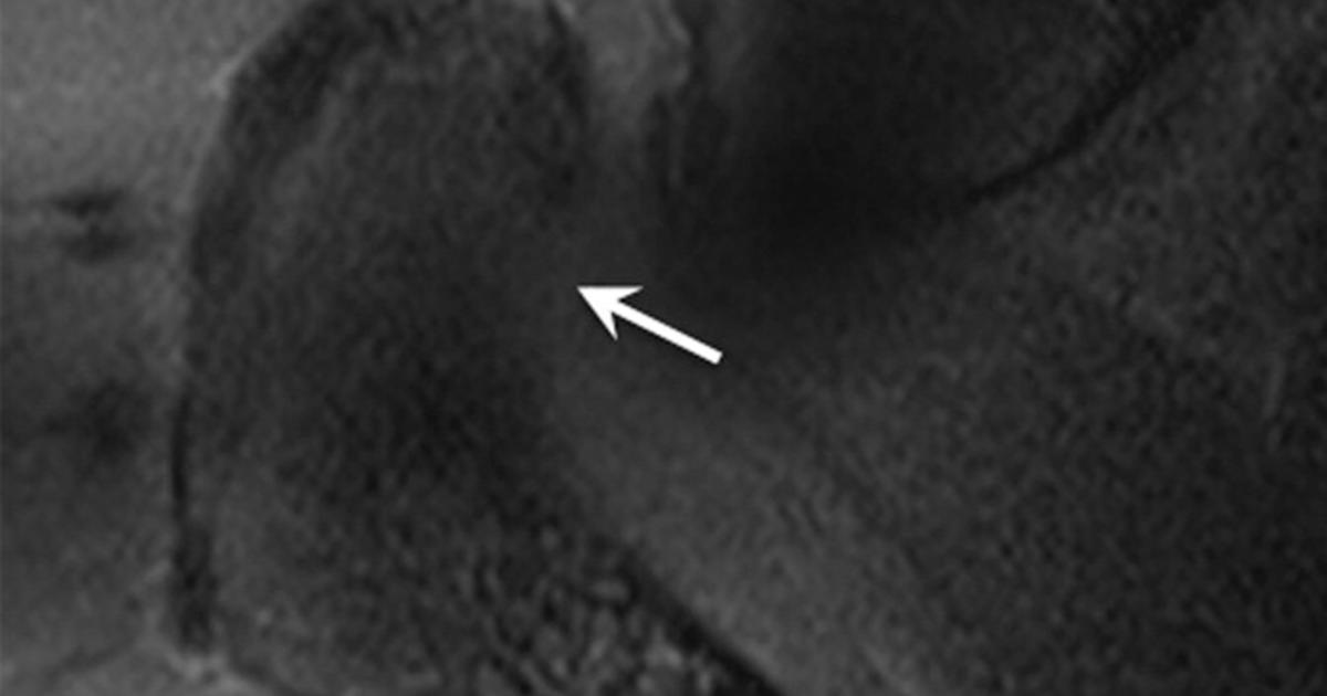 Newly described shoulder injury spotted on MRIs of young pitchers