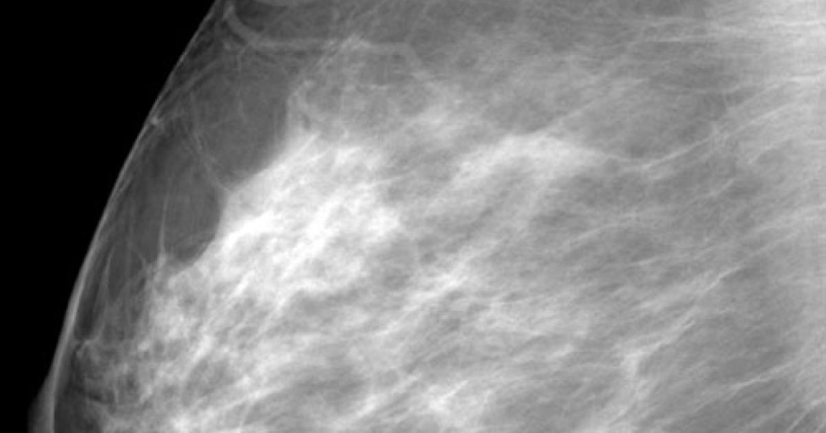 New AI tool accurately classifies breast density