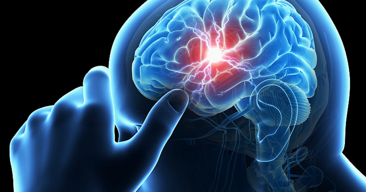 Female stroke victims less likely to receive specialized imaging than men