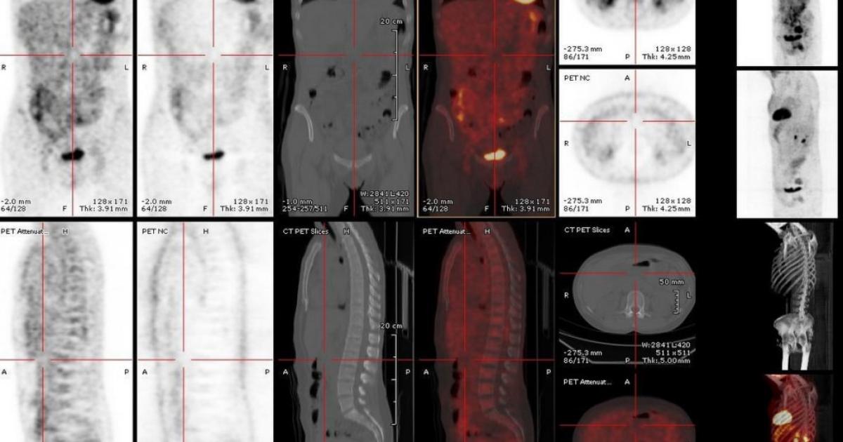 Whole body PET/CT finds some tricky cancers better than CT alone