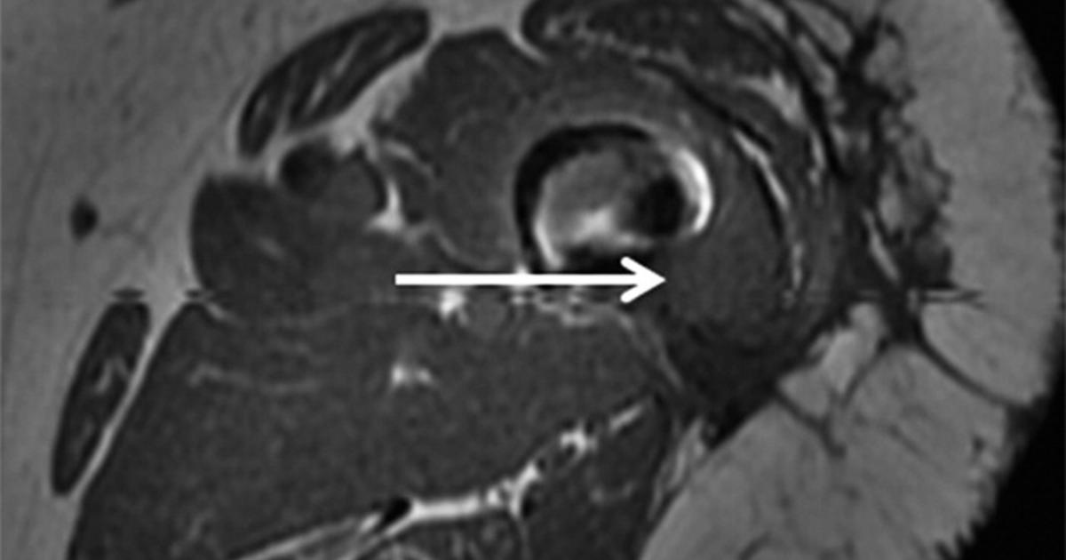 Functional MR sequence addition to MR protocol better distinguishes ...