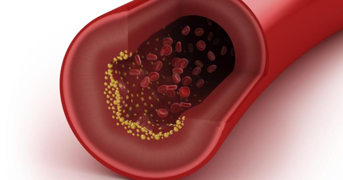 CT scans reveal link between low skeletal muscle mass and coronary ...