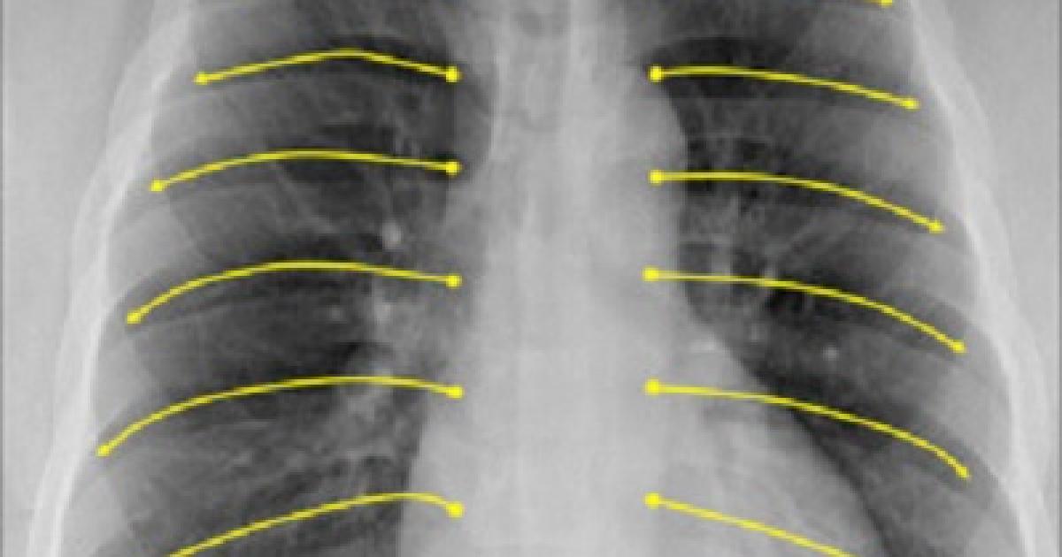 Nonradiology trainees prefer, excel with simulated chest radiography