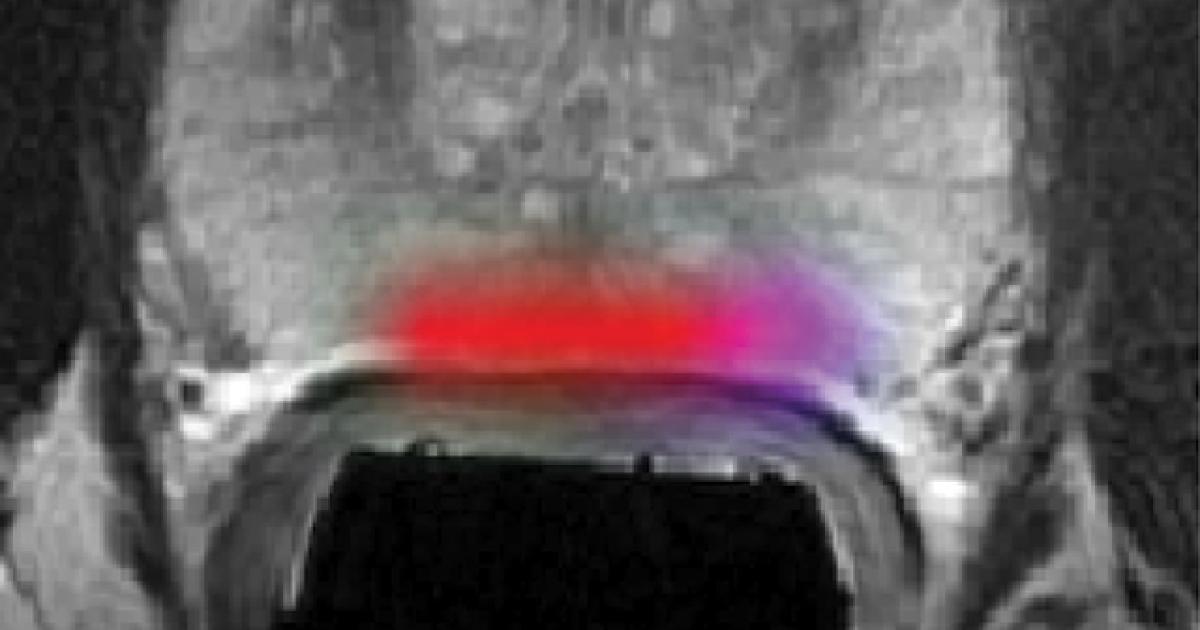 MR in Hyper-drive: Introducing Hyperpolarized MRI & A New Era of ...