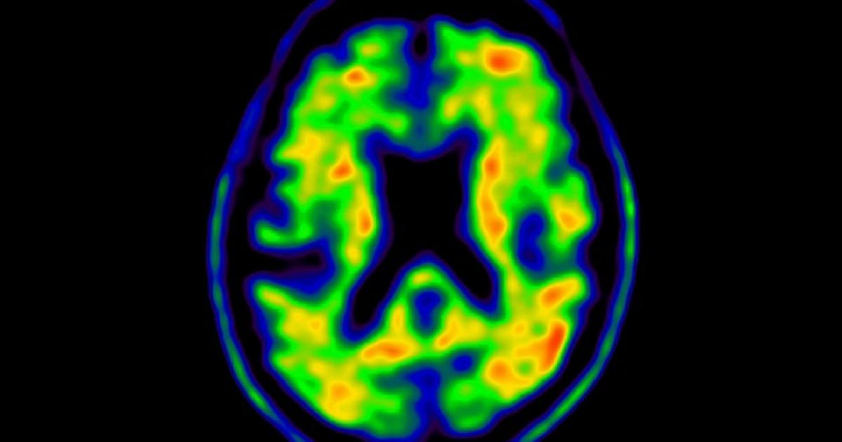 Imaging offers insight into impact of new Alzheimer's treatment from ...