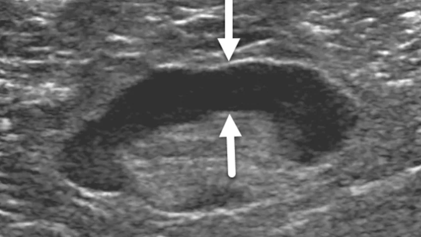 breast cancer pictures ultrasound