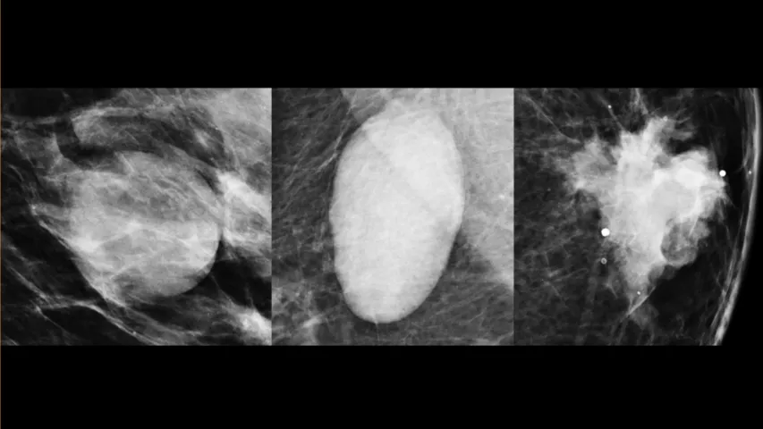 abnormal mammogram