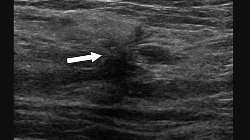 recalled from mammogram