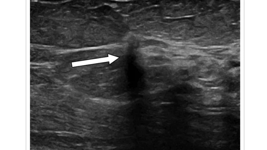 breast cancer pictures ultrasound