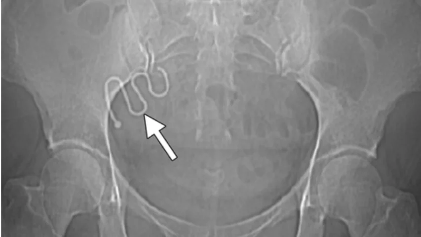 rectal foreign body ct