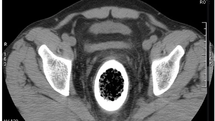 rectal foreign body ct