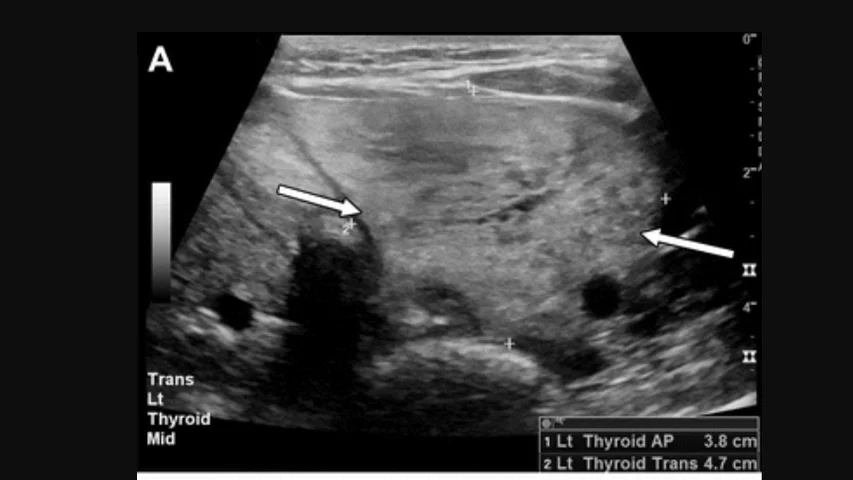 multinodular goiter usg