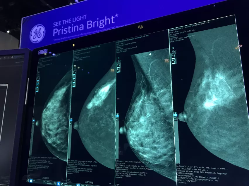 4 key trends in breast imaging