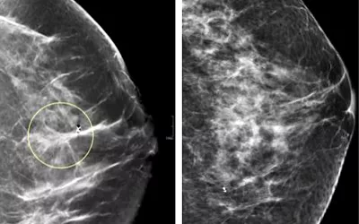 found something on mammogram