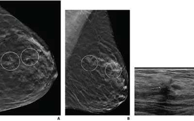PHOTO GALLERY: What does breast cancer look like on mammography