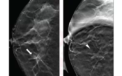 PHOTO GALLERY: What does breast cancer look like on mammography