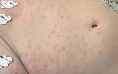 PHOTO GALLERY: What does COVID-19 look like on medical imaging?