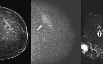 PHOTO GALLERY: What does breast cancer look like on mammography