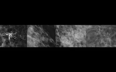 PHOTO GALLERY: What does breast cancer look like on mammography