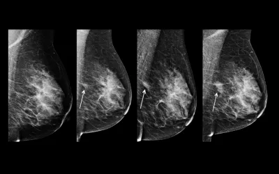 PHOTO GALLERY: What does breast cancer look like on mammography
