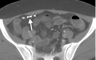 rectal foreign body ct