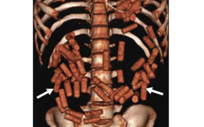 PHOTO GALLERY: Abdominal, pelvic and rectal foreign bodies
