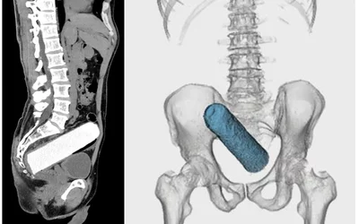 PHOTO GALLERY: Abdominal, pelvic and rectal foreign bodies