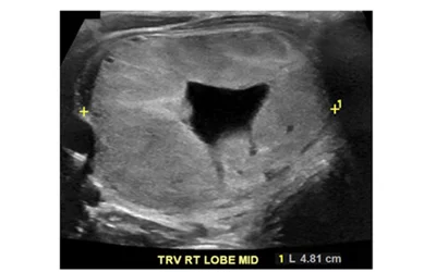 PHOTO GALLERY: What do thyroid nodules look like on imaging
