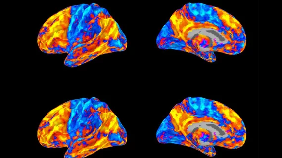 Brain MRI links poor brain connectivity to increased risk of mental illness