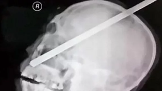 impaled through the head