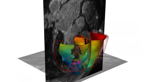 3D heart model uses MRI to pinpoint source of arrhythmia