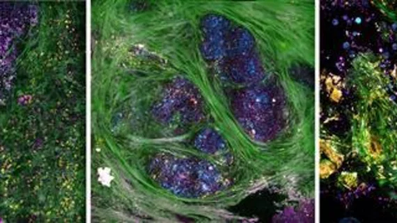Optical imaging system visualizes molecular features of breast cancer ...