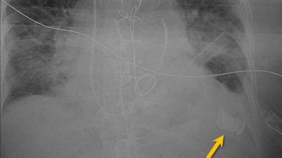 What radiologists should know about spotting items left in patients ...