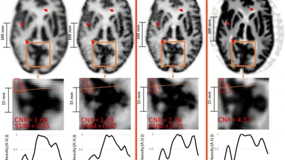‘Super-resolution’ PET utilizes unwanted movements to bolster brain imaging