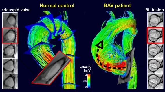 4D flow MRI has potential role for detecting complications in patients ...
