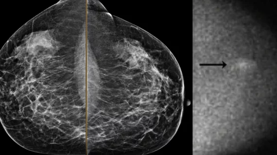 can mammograms increase risk of breast cancer